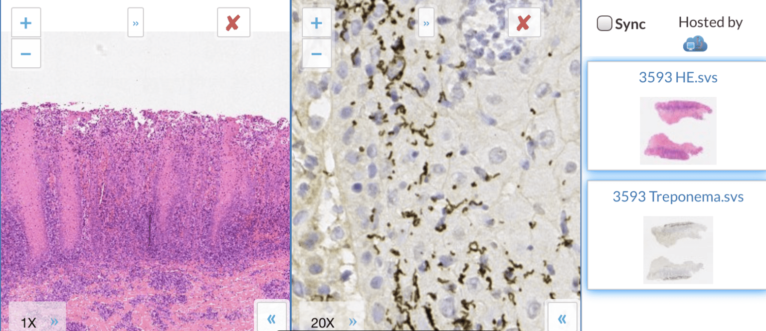 Oral syphilis – Pathkids.com website of the South West Pathology Trainees